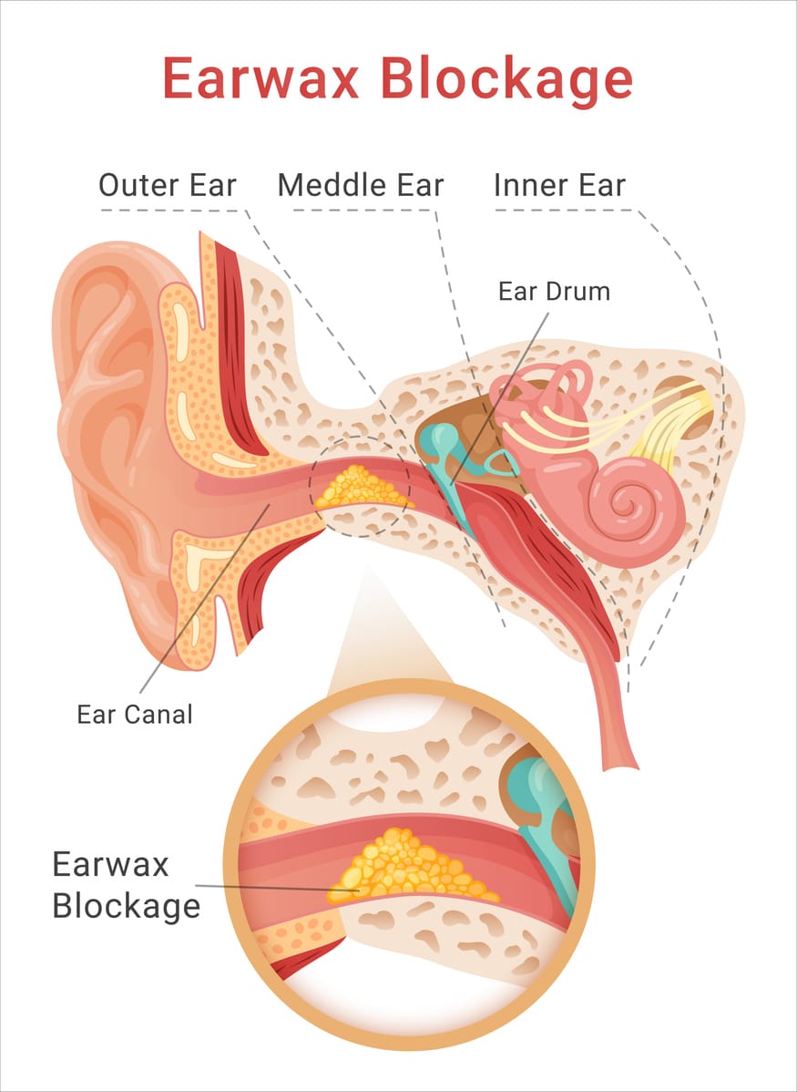 What Causes Excessive Earwax? A Comprehensive Guide - Out With The Wax